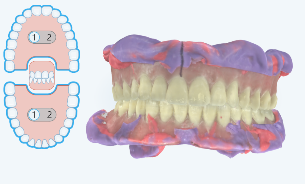 Digital Dentures - Leixir Dental Laboratory Group